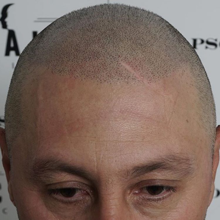Scalp Society - Scalp Micropigmentation San Francisco